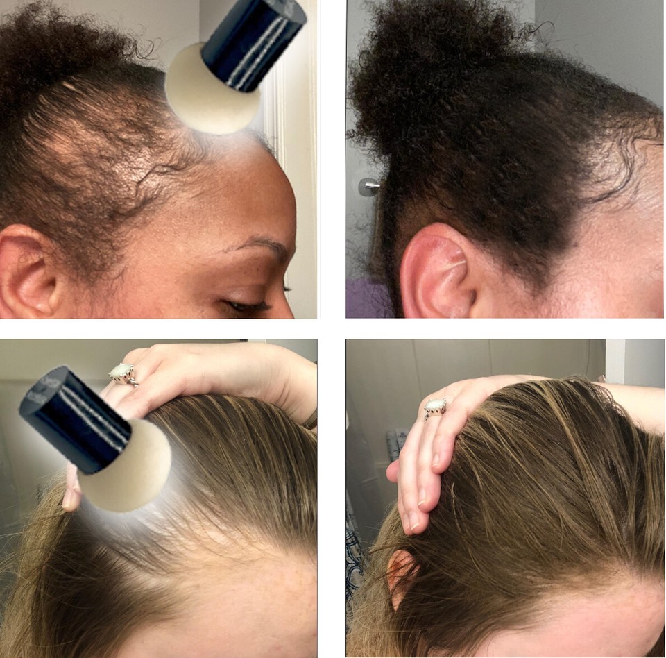 Extra Large Hairline Filler Root Touch-Up Hair loss Concealer Bald Spot ...
