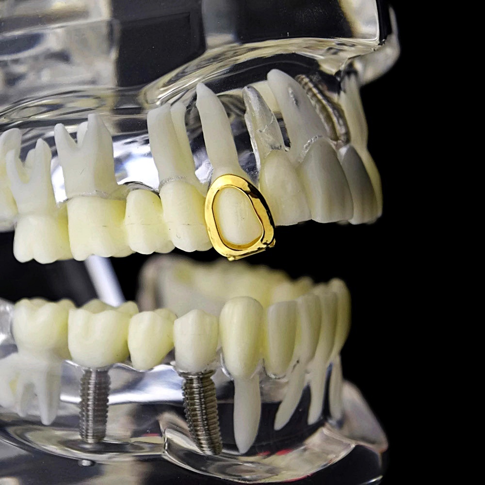 Single Gold Tooth Cap