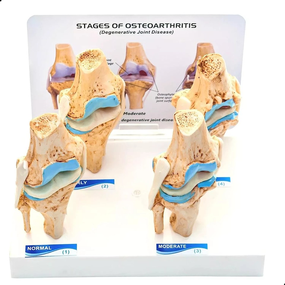 KNEE JOINT ARTHRITIS MODEL 4 Stage Osteoarthritis Anatomical Body Model ...