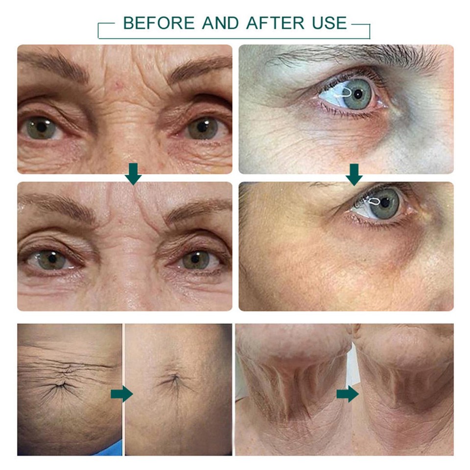 Fibroblast Plasma Pen Face Wrinkle Spot Removal Skin Lifting Eyelid ...