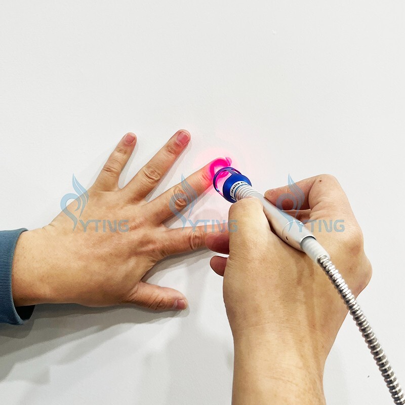 980nm Diode Laser Toe Nail Fungus Removal Toenail Infection Treatment ...