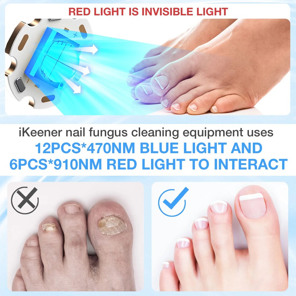 Nail Fungus Laser Treatment LED Light Device for Multiple Toenails ...
