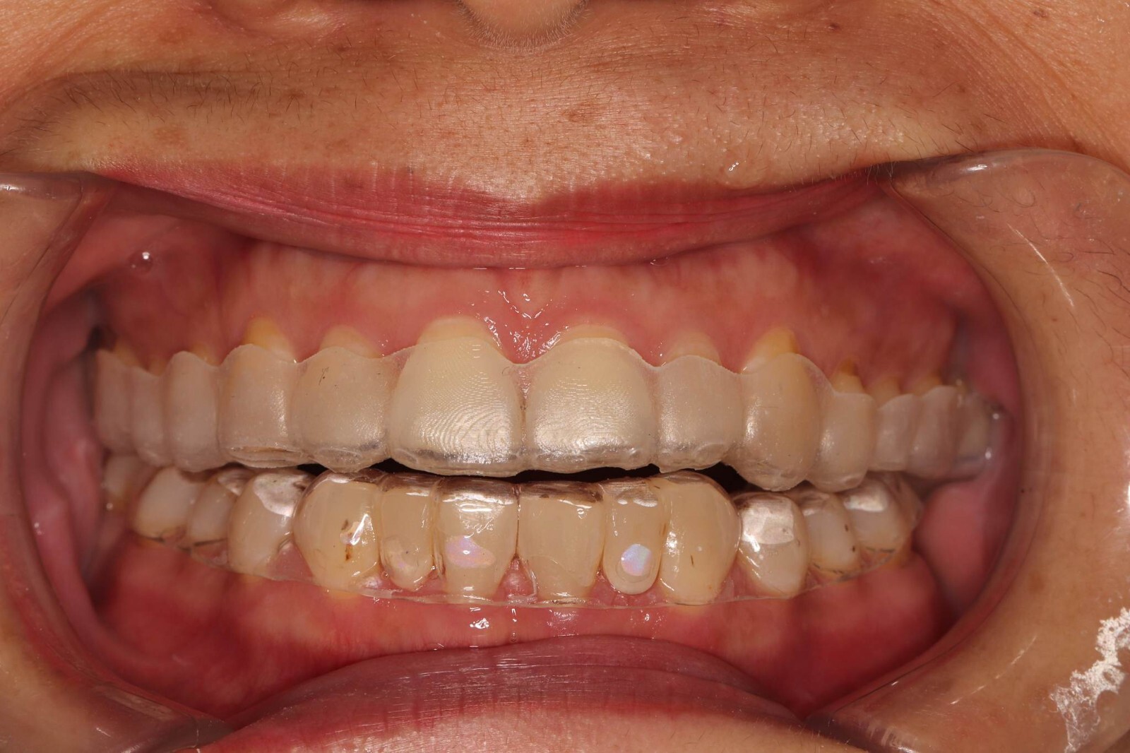 DLP SLA LCD 3d printer CLEAR ALIGNER resin | eBay