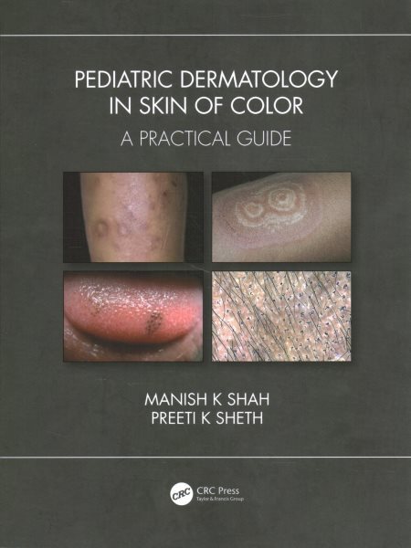 Pediatric Dermatology in Skin of Color : A Practical Guide, Paperback ...