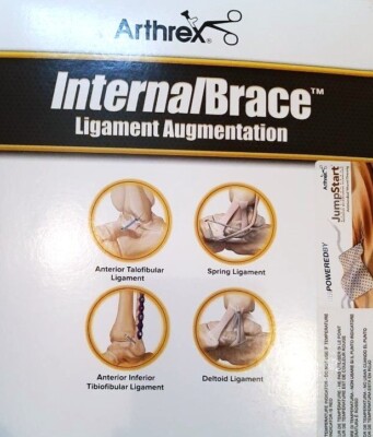 Arthrex InternalBrace Ligament Augment Repair Kit AR-1788J-CP Exp: 2023 ...