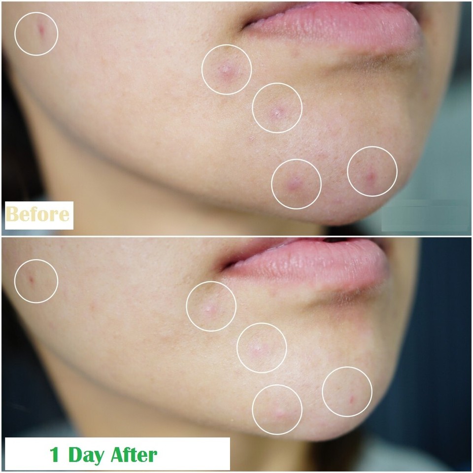 2x10g Smooth E Hydrogel Plus Gel Anti Acne No Head Eliminate Oil ...