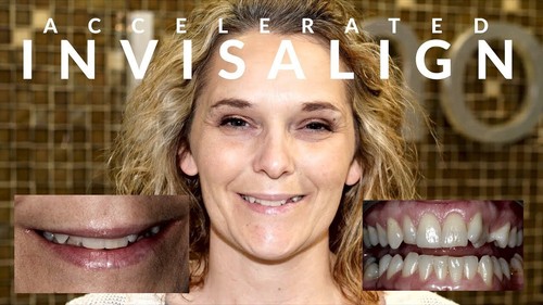 Viber20 Vibrations Seater for Aligners Like Invisalign Fixed Braces for ...