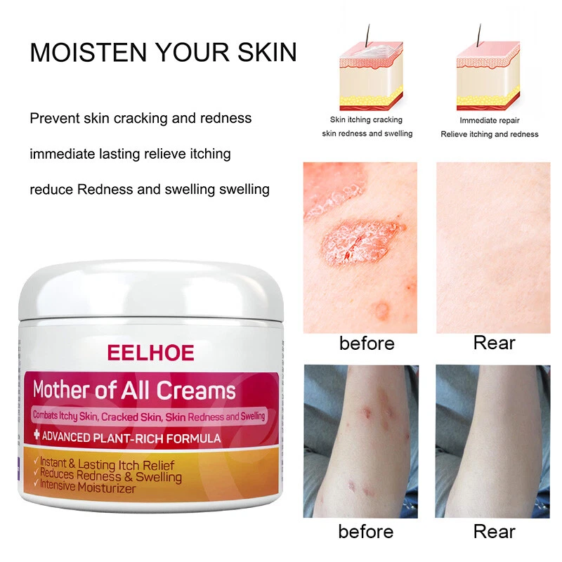 Dermatitis Treatment Cream