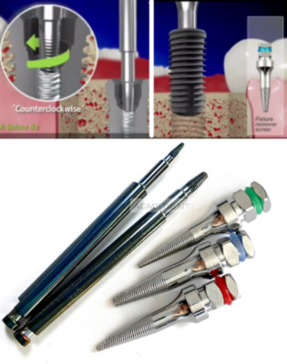 Dental Fixture Fractured Broken Screws Failed Implant Extractor Screw ...