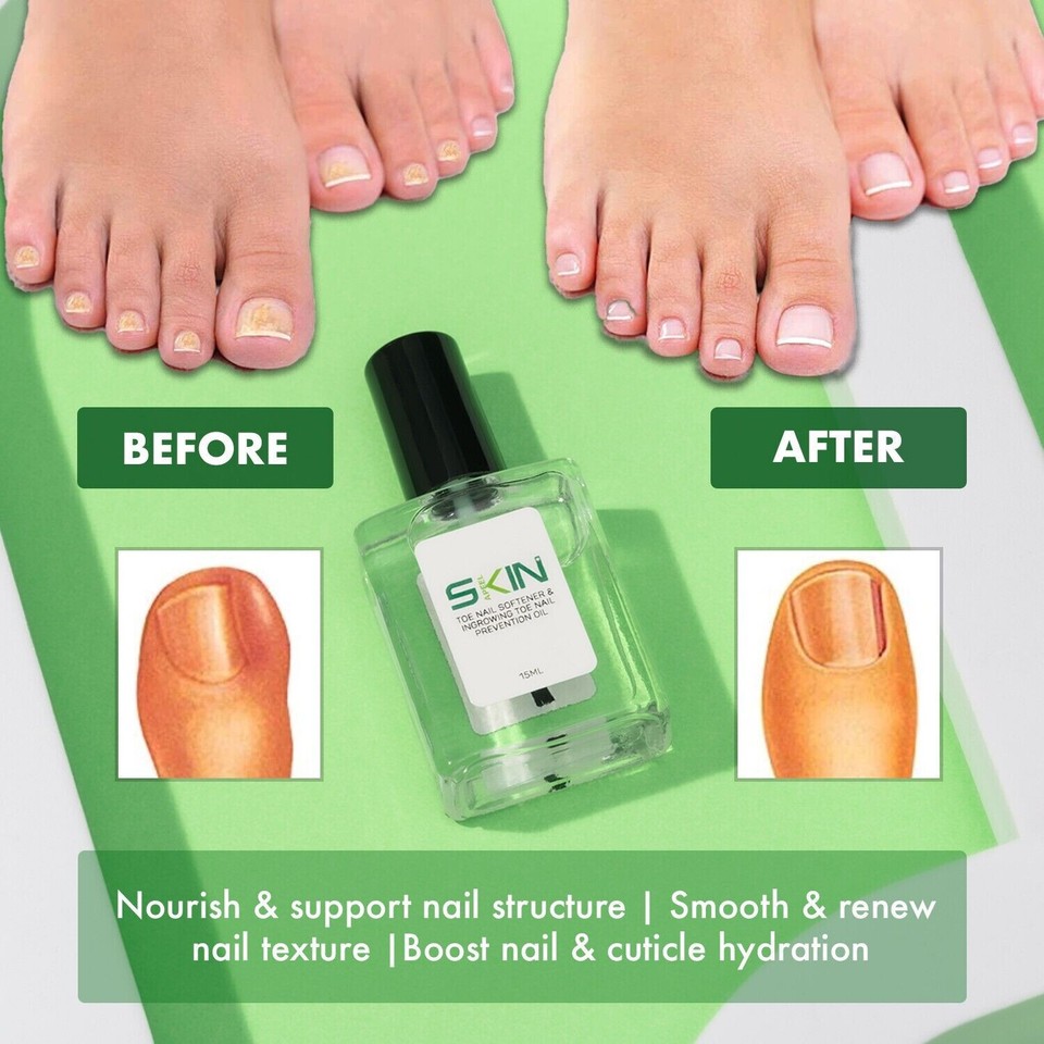 Toe Nail Softener Softens Ingrown Toenail Treatment Oil for Hard Thick ...