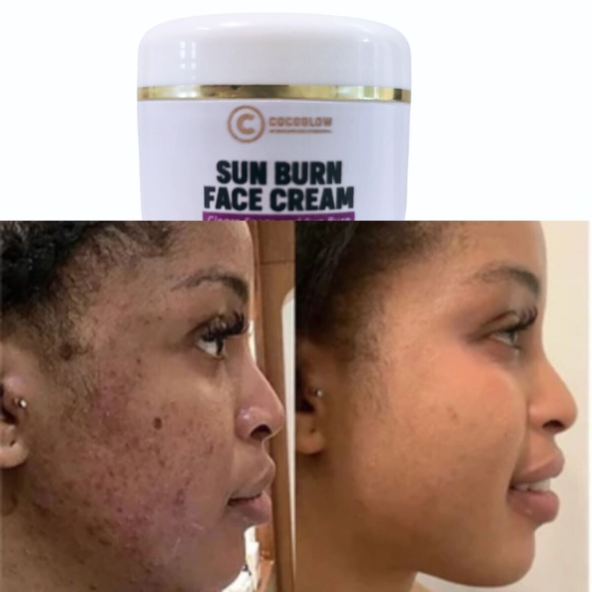 Sunburn Remover Face Cream melasma Dark Spots Fade Cream 50ml eBay