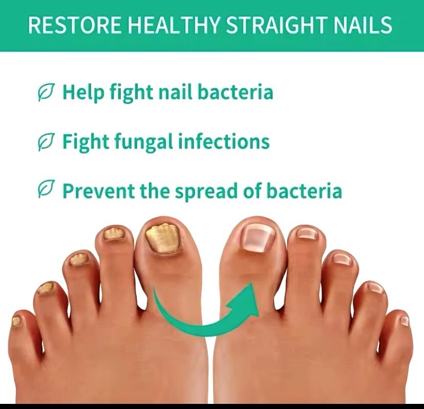 FUNGUS 7 DAYS NAIL FUNGUS TREATMENT ALL NATURAL FORMULA WITH GINGER AND ...