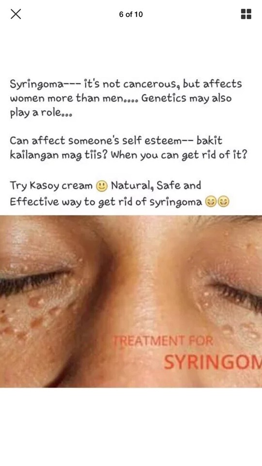 Lot 2 Syringoma Cream Remove Syringoma Scarless Cream Fade and Lighten ...