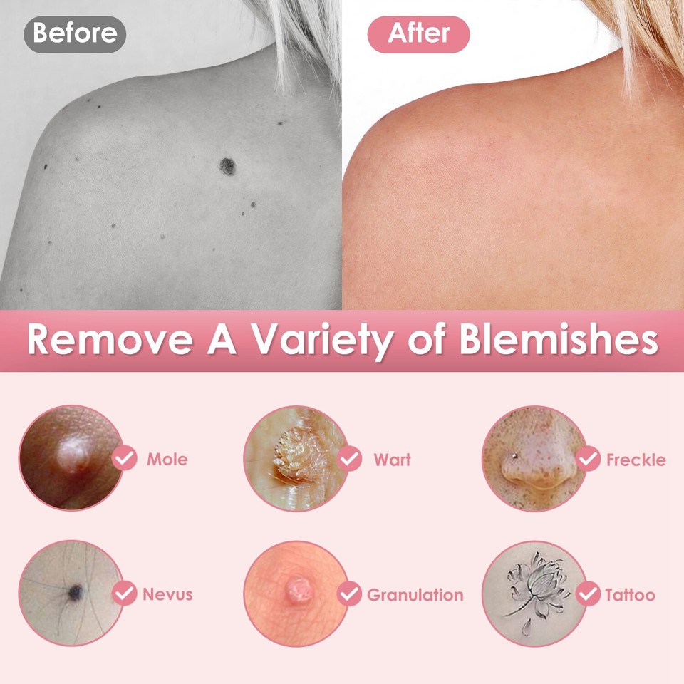 Skin Tag Remover Skin Tag Repair Kit Tattoo Freckle Wart Mole Remover ...