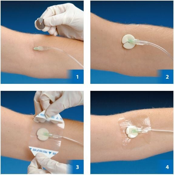 DeRoyal # 46-iv22 Algidex AG IV Catheter Patch - 5pcs for sale online ...