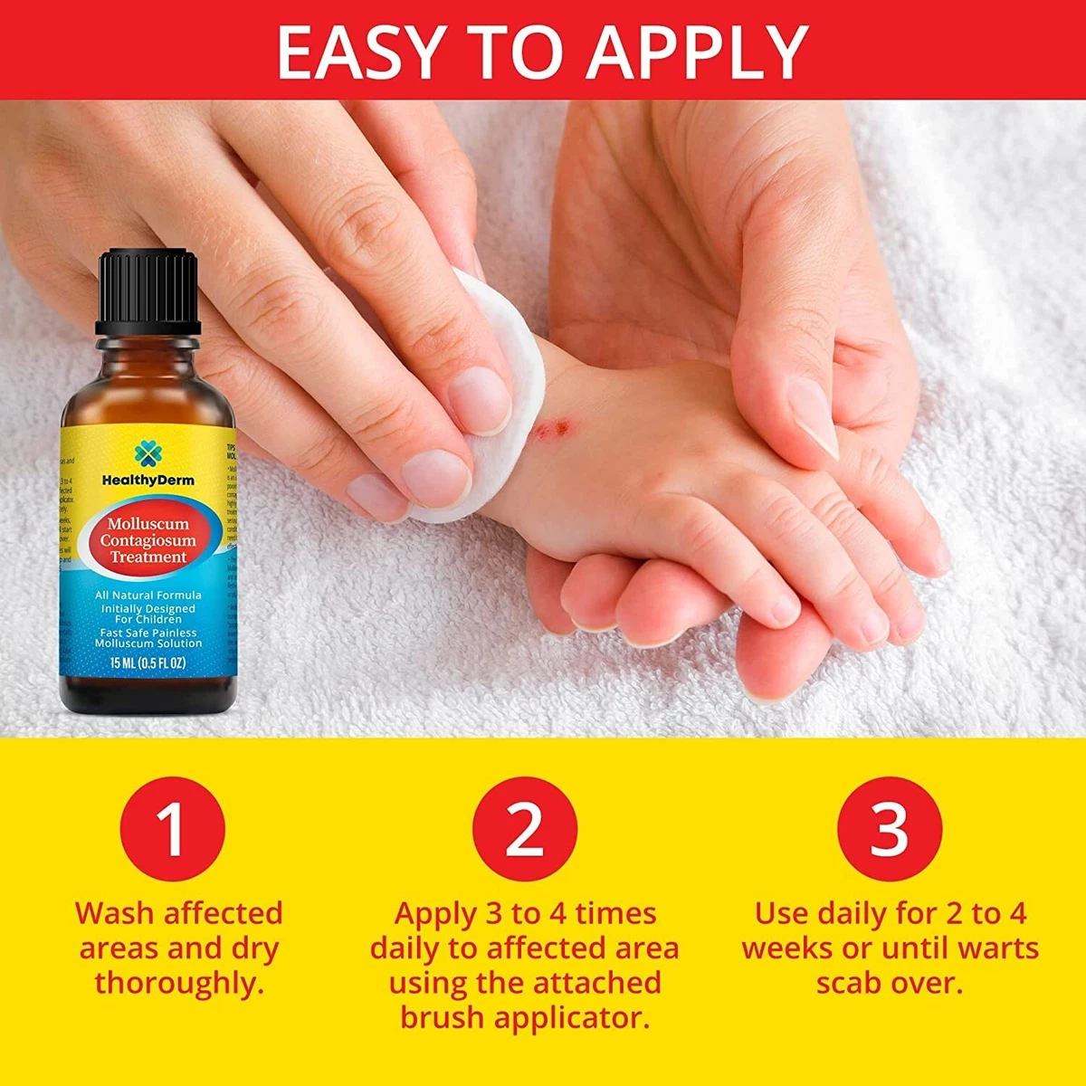 Molluscum Contagiosum Treatment