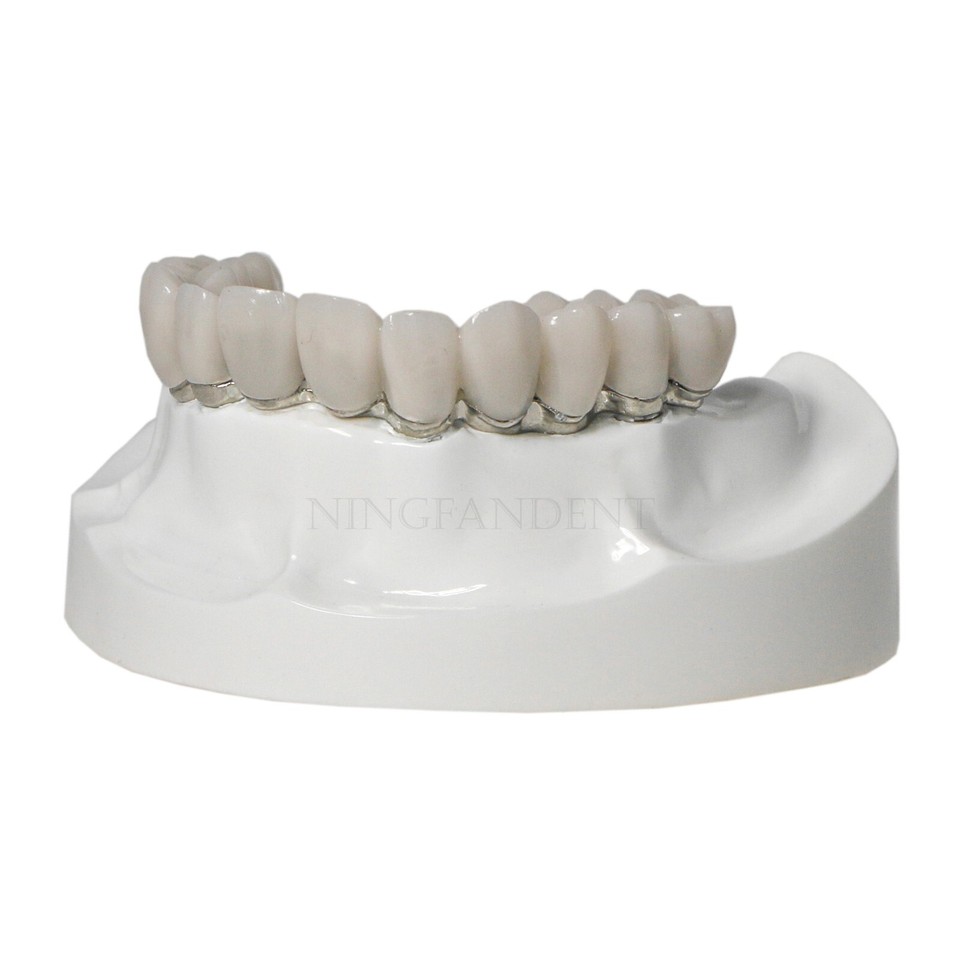 Dental All-On-4 Overdenture Implant Model Upper Pure Titanium Bridge, 4 ...