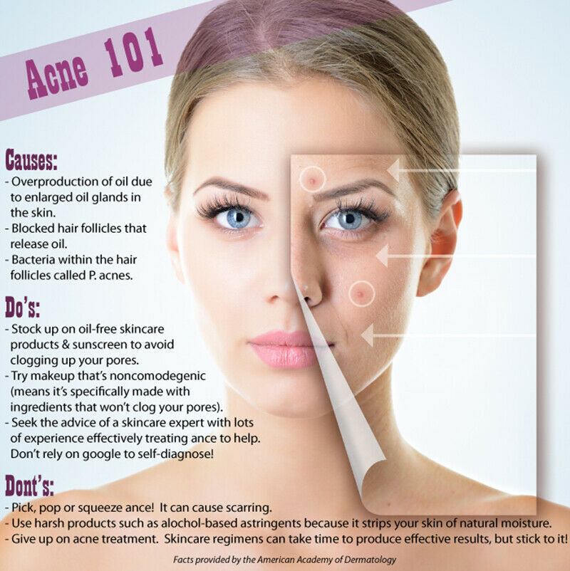 Lactic Acid Skin Peel For Acne Wrinkles Melasma Age Spots 25% 40% 50% ...