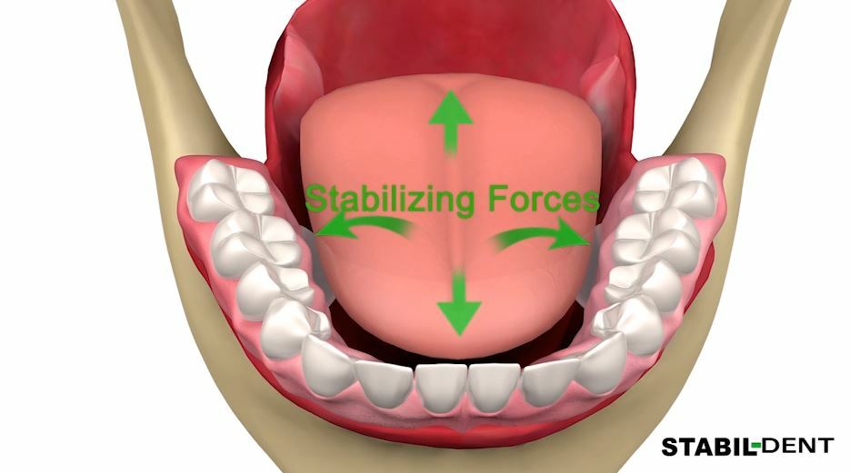 Lower Denture Stabilizers DIY Kit-Affordable Denture Stabilization | eBay