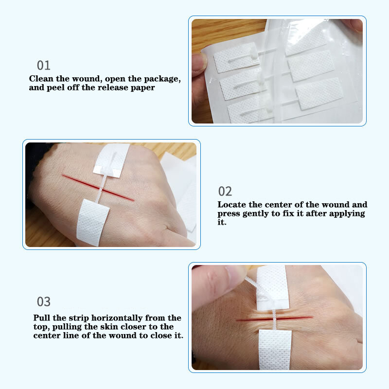 Band-Aid Zipper Tie Wound Closure Patch Hemostatic Patch Wound Zipper ...