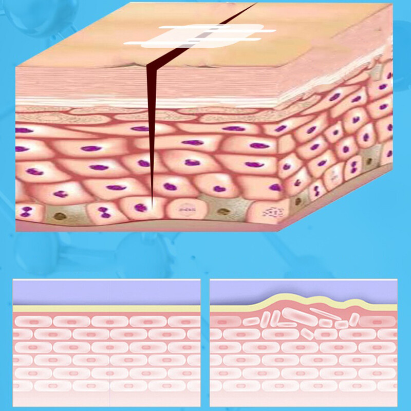 10 Buckles Zipper Band-aid Suture-free Wound Dressing Patches ...