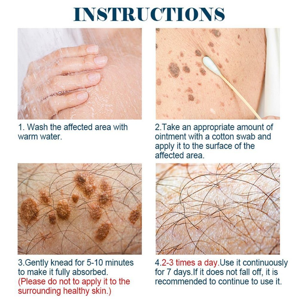 Verruca Removing Cream Private Wart Remover Warts Liquid Warts Cream ...