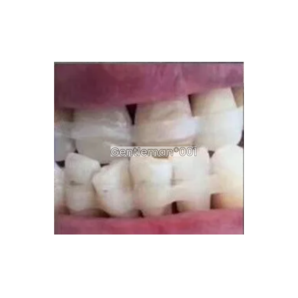 Dental Flexible Fiber Strip Band Retainer Glass Splint Loose Tooth ...