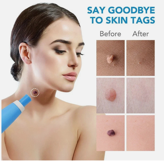 Auto Micro Skin Tag Remover Device Kit Safe Painless Removal 2-8 mm ...