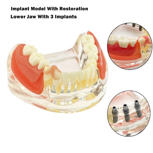Dental Implant Restoration Teeth Model Removable Bridge Partial Tooth ...