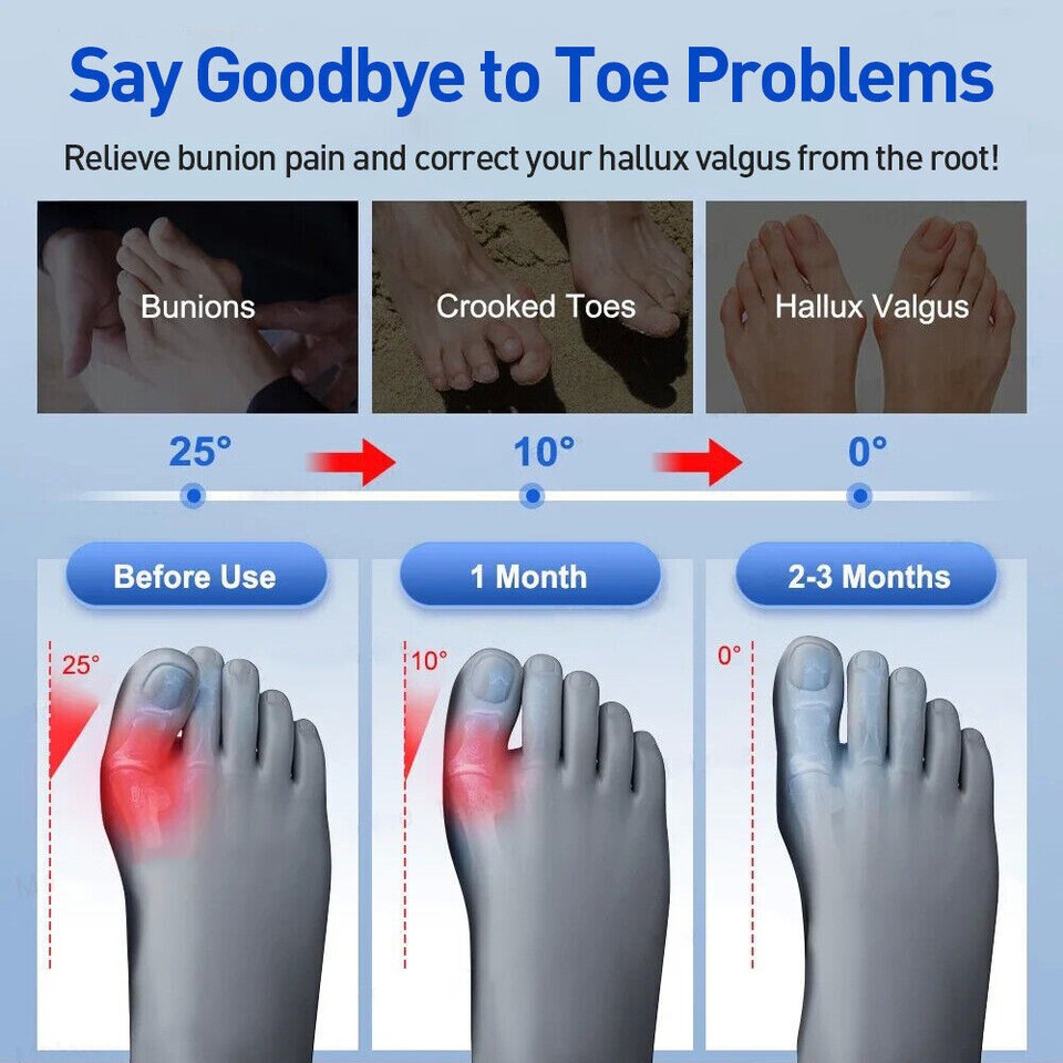 Bunion Fix Toe Hallux Valgus Orthopedic Bunion Corrector Big Toe ...