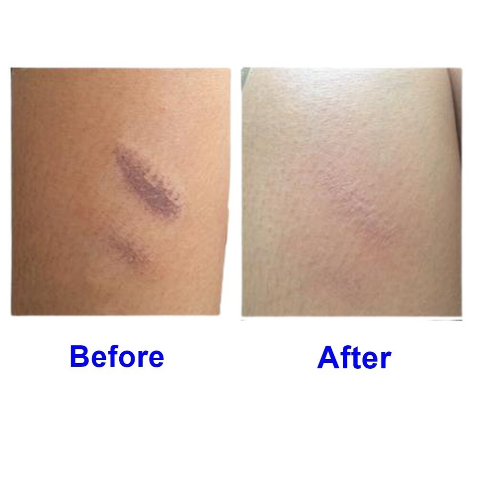 Cream Hirudoid Relieves Scars Bruises Varicose veins Skin Inflamed 10 ...