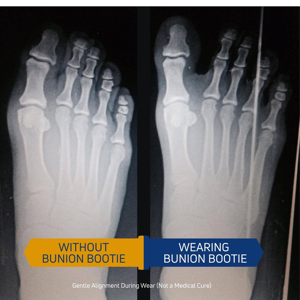 Med-Right Bunion Corrector Big Toe Straightener Ultra-Thin Brace Shoe ...