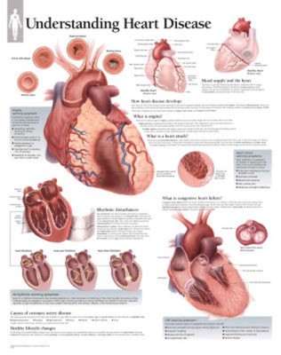 Understanding Heart Disease chart: Laminated Wall Chart | eBay UK