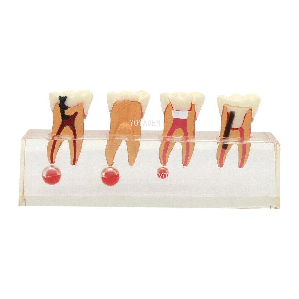 Dental Teeth Model Periodontal Disease Assort Model Endodontic Teaching ...