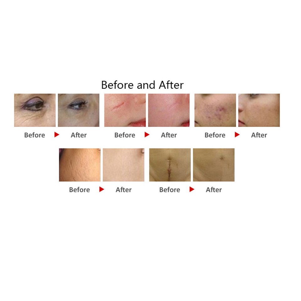 Fractional Co2 Laser Machine Acne Scar Marks Removal Skin Tightening ...