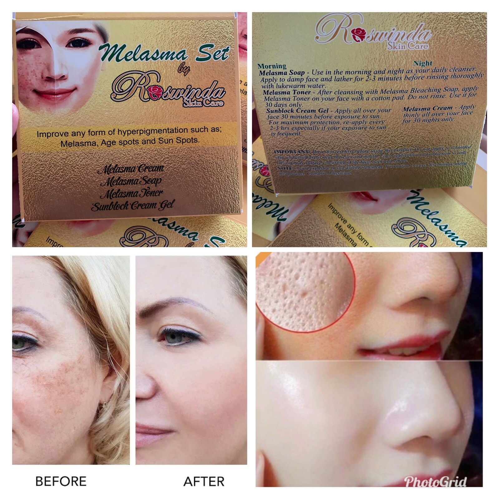 Melasma Set Remove Dark Spot Blemishes Acne Pimples Hyperpigmentation ...