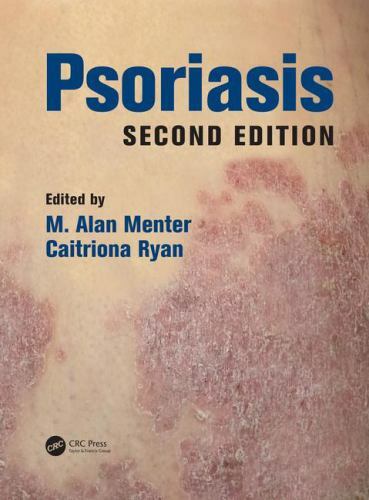 Psoriasis, Hardcover by Menter, M. Alan, M.D. (EDT); Ryan, Caitriona, M ...