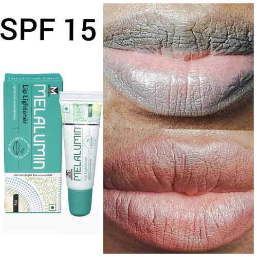 Melalumin Lip Lightener SPF 15 help Lighten & Brighten Dark or ...
