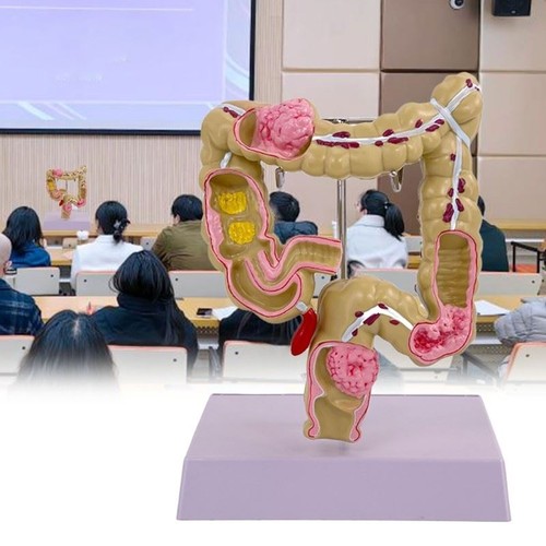 Human Large Intestine Model Pathologies of Large Intestine Model ...
