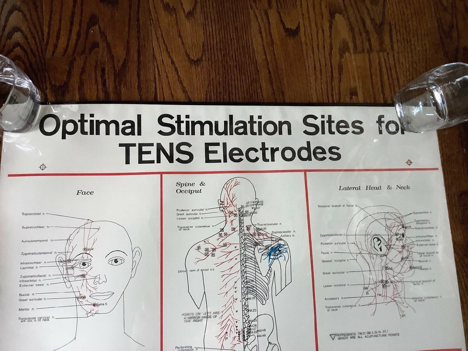 Vintage 1980 Dynex Neurostimulator Stimulation Electrodes Medical Chart ...