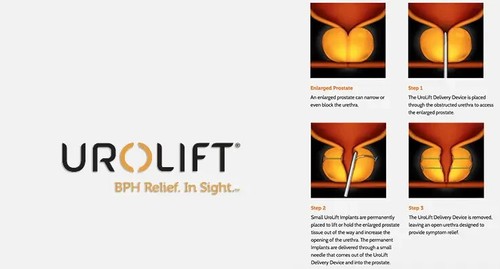 NeoTract TeleFlex UroLift UL400-4 System, in sterile package | eBay