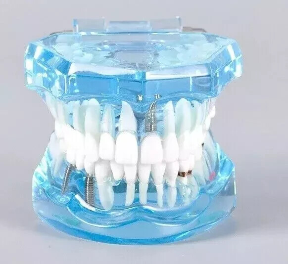 Dental Typodont Teeth Model Ortho Implant Pathological Perio Practice ...