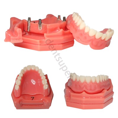 Dental Implant Model Demonstration Semi-oral Movable Tooth Mold ...