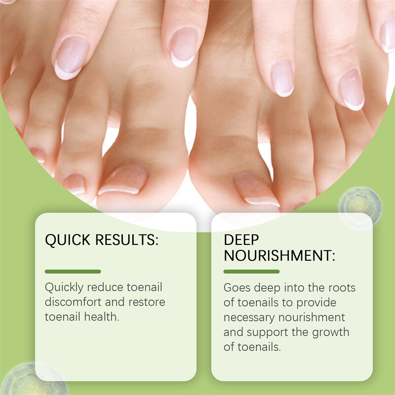 Nail Treatment Fungus Anti Fungal Toe Removal Care Infection Liquid ...