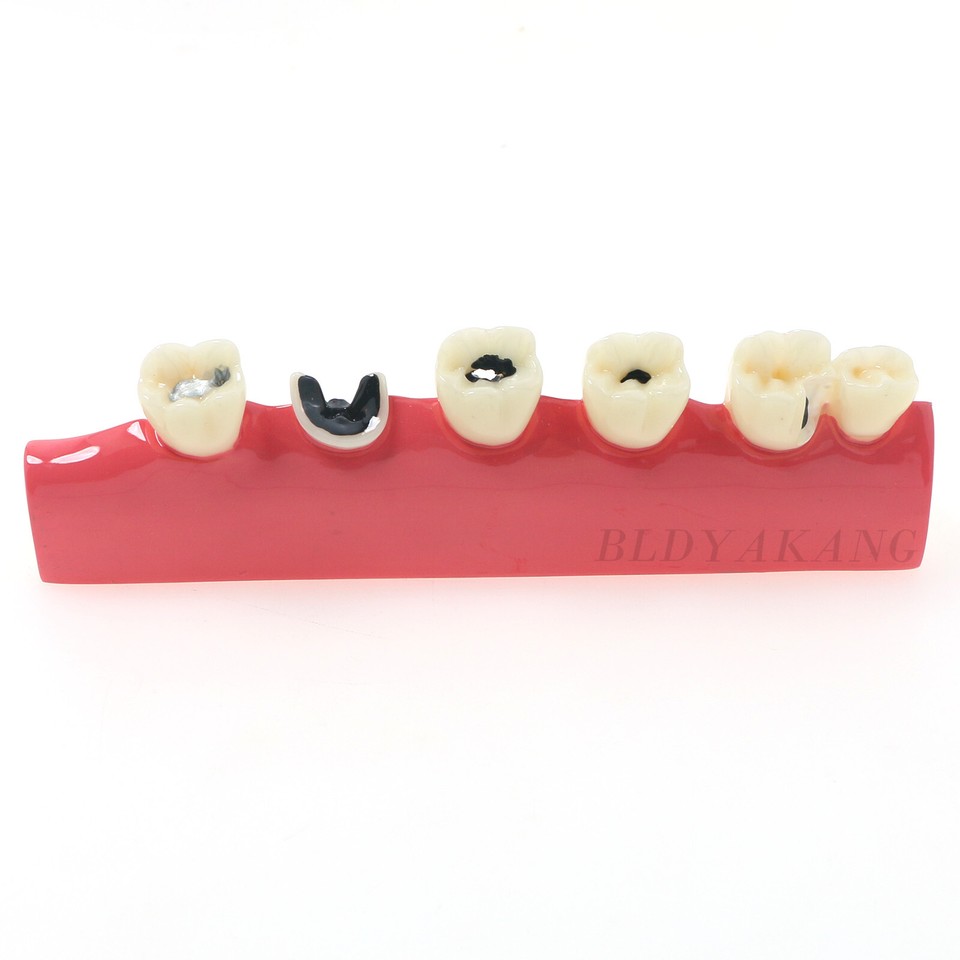 Lab Periodontal Disease Assort Tooth Typodont Teeth Model Study 5-Stage ...