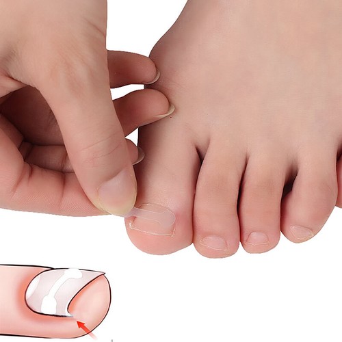 10Pcs Ingrown Toe Nail Correction Sticker Patch Paronychia Corrector ...