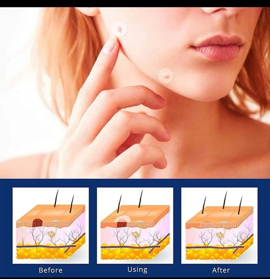 144pcs Skin Tag Remover Patches Quick Effective Mole Wart Removal Pad ...