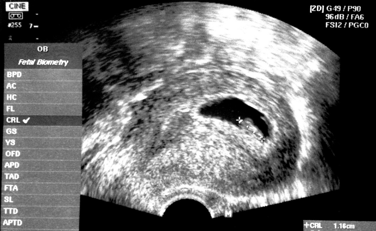Baby In Uterus Ultrasound
