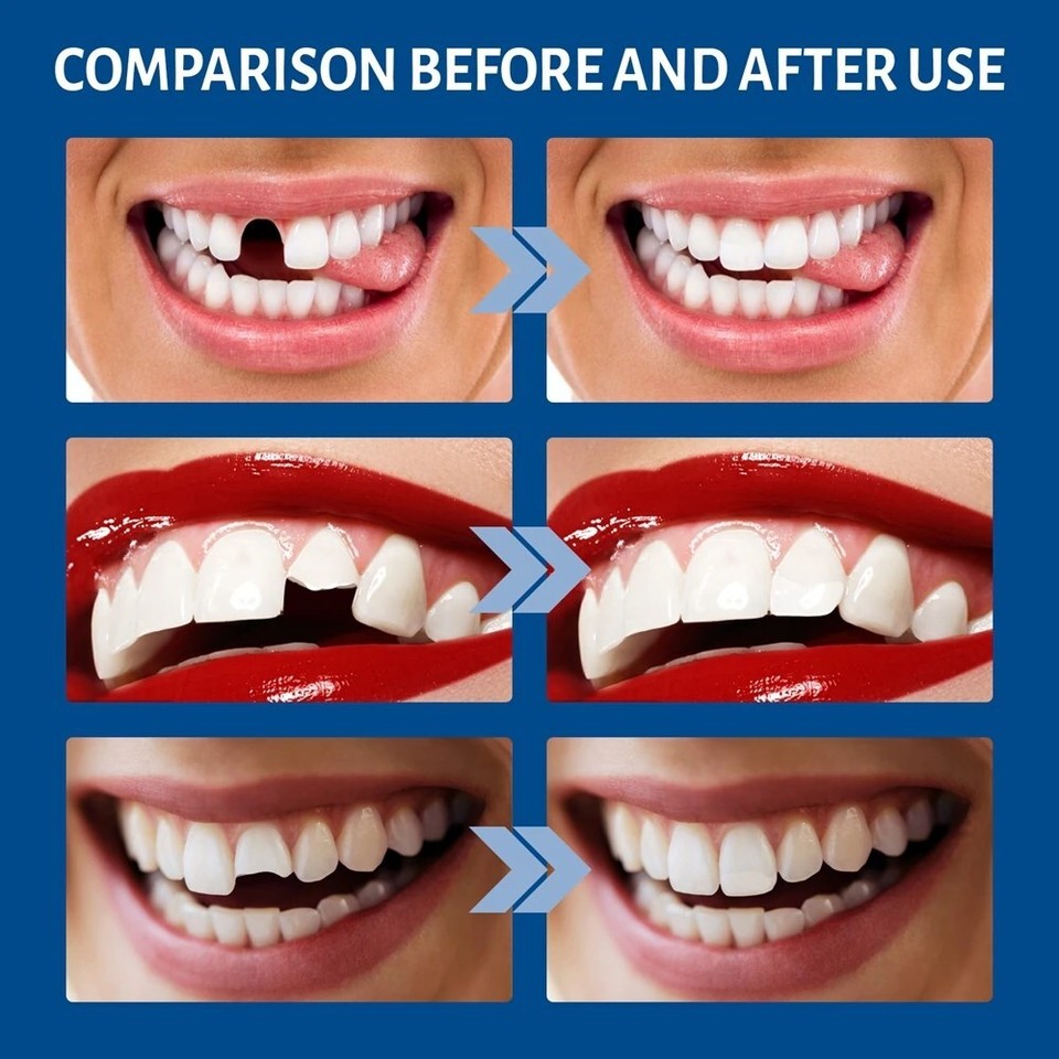 Temporary Strong Teeth Tooth Repair Dental Cement Cavity Filling Kit ...