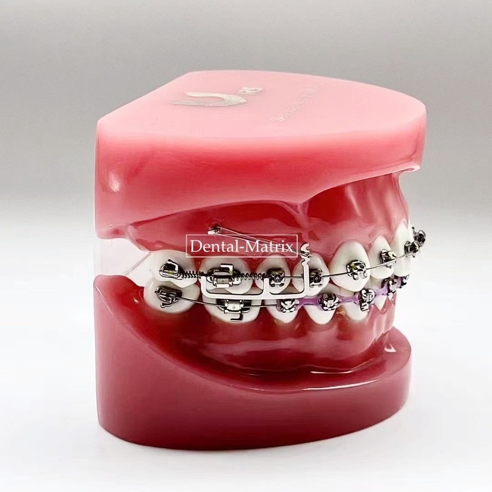 Dental Orthodontic Appliance Molar Pusher Distalizer Lingual Brackets ...